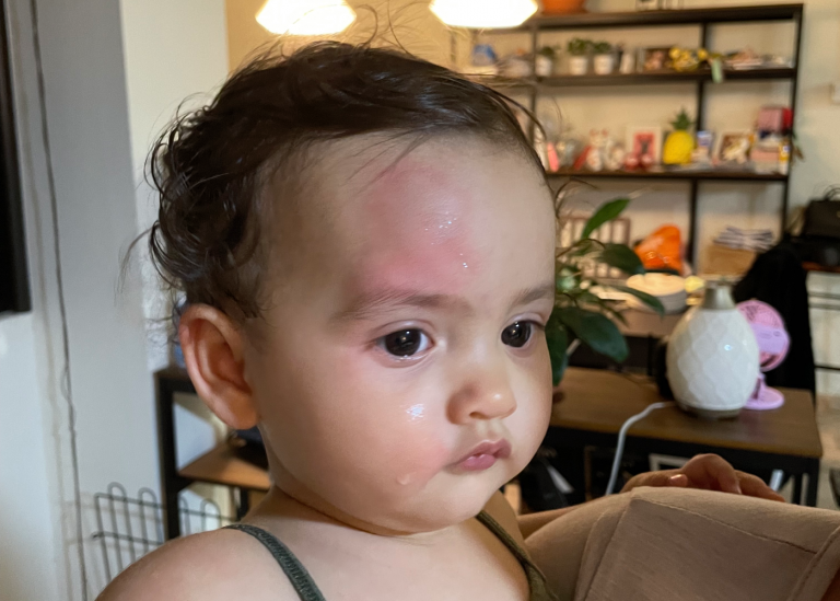 All you need to know about head injuries in kids | HoneyKids Asia